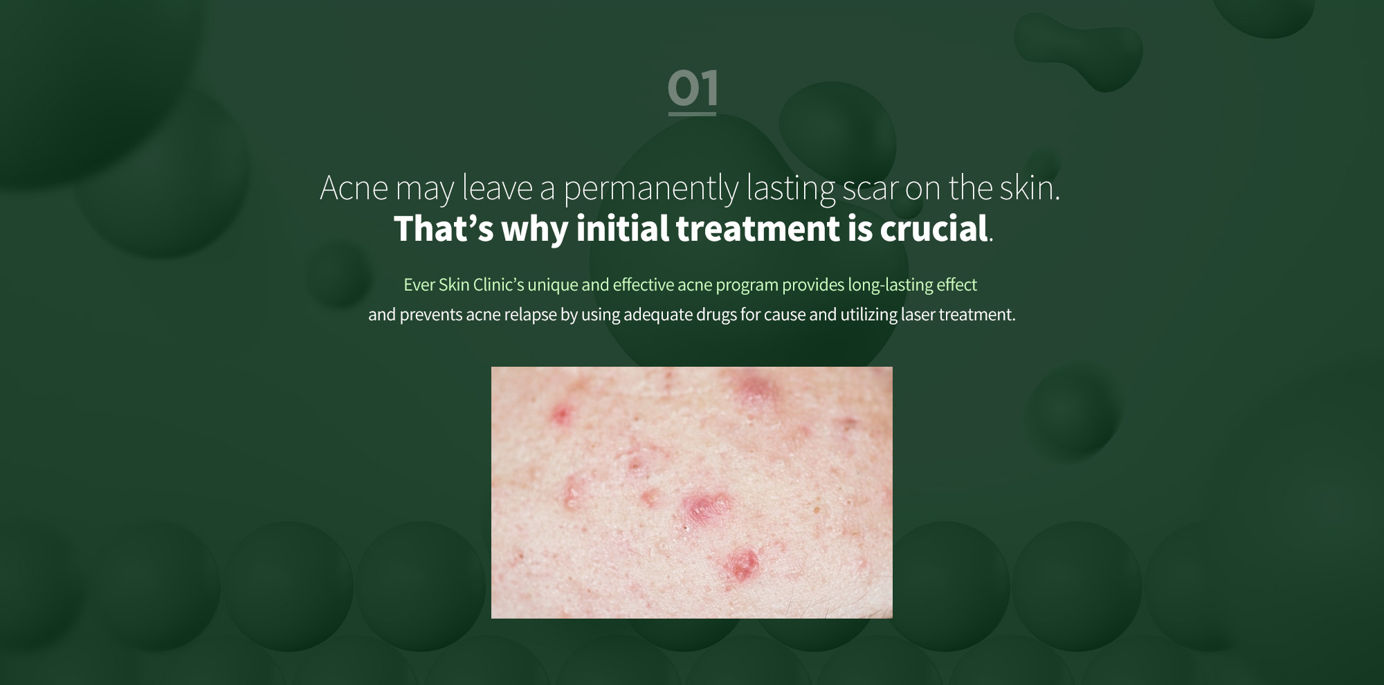 Acne : EVER SKIN CLINIC